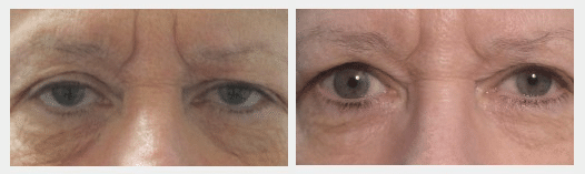 Ptosis Chesapeake Va Ptosis Treatment Chesapeake Va