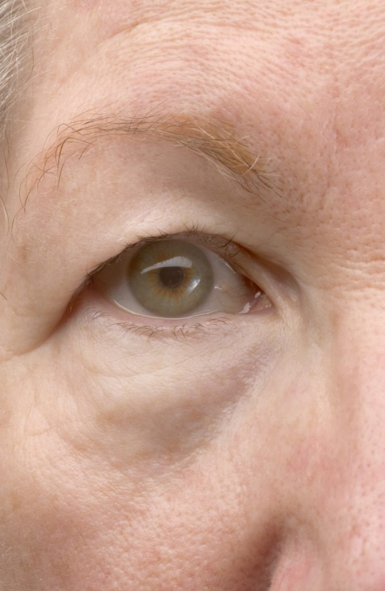 Blepharospasm Treatment Chesapeake - Eye Surgery Portsmouth